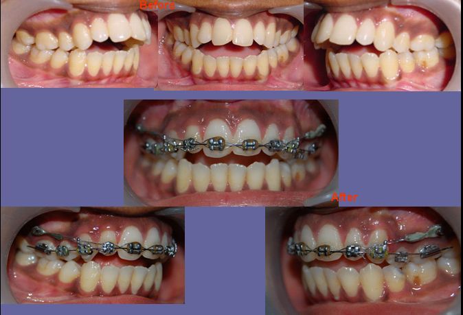 Microimplant screw for Anchorage